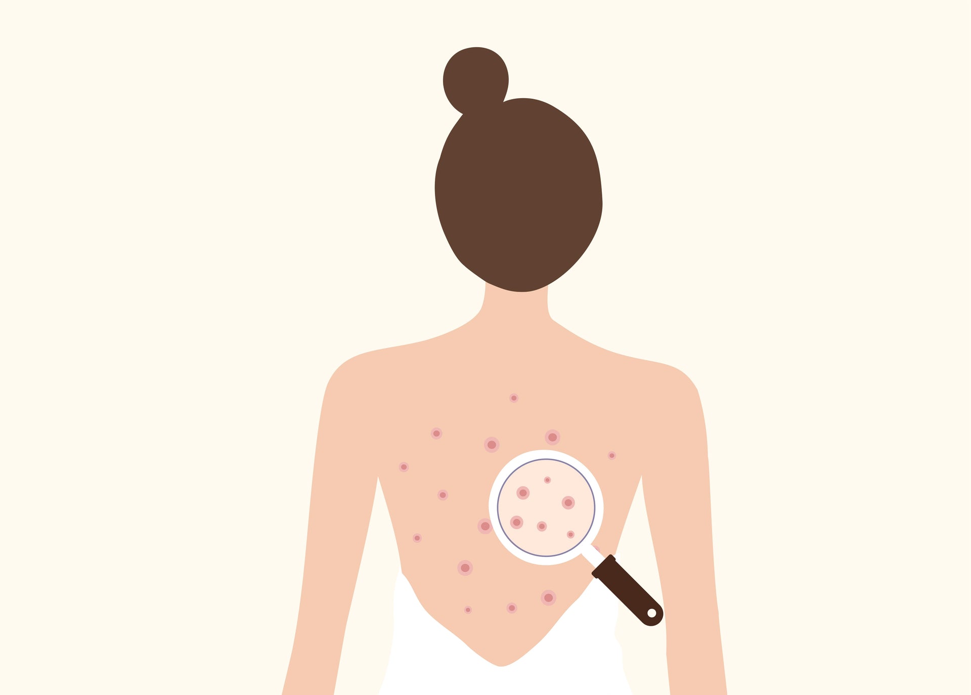 Beat Bacne, Butt-ne, and Chest-ne This Summer! – Skin Property Esthetics